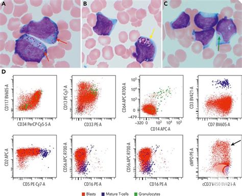 Pediatric Mixed Phenotype Acute Leukemia T Myeloid With Isolated Flt3
