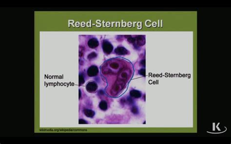 Hodgkin Lymphoma Flashcards Quizlet
