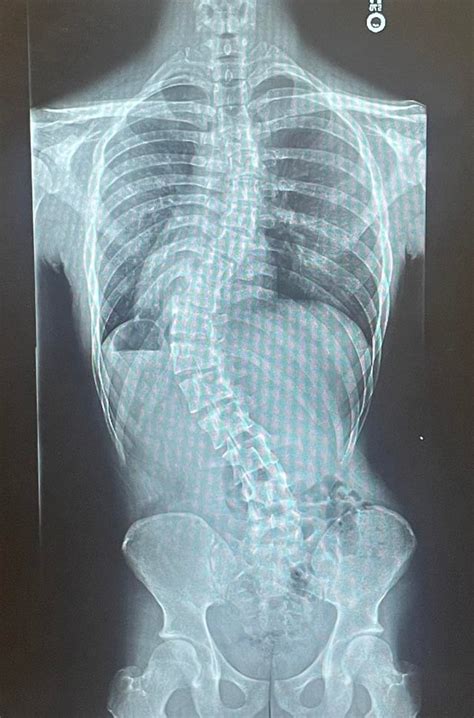 Back Pain With A 35 Degree Curve Rscoliosis