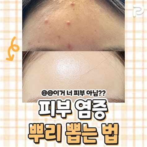 피드뷰티 피부에 딱딱한 여드름 많이 나는 사람 주목 염증에 좋은 것들 알려줄게 칭9야 이거 참고해봐 피부관리꿀팁