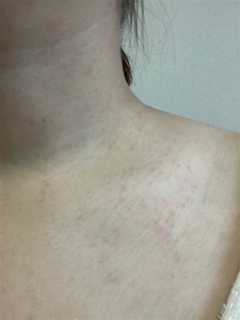 昨日から腕にこのような赤い斑点が出ました。かゆくもなんともないです。た Yahoo知恵袋