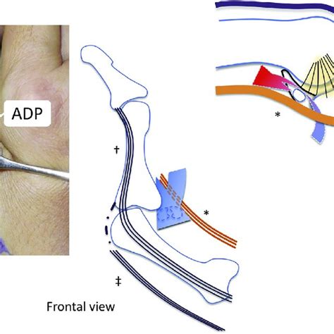 Plain Radiograph Of A Normal Thumb Left And Type I Deformity Of A