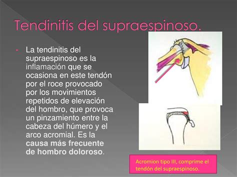 PPT Tendinitis Del Supraespinoso PowerPoint Presentation Free