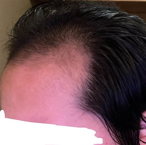 Two Months On Topical Minoxidil Derma Roller Rtressless