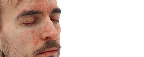 Discoid Lupus Erythematosus Oral Lesions
