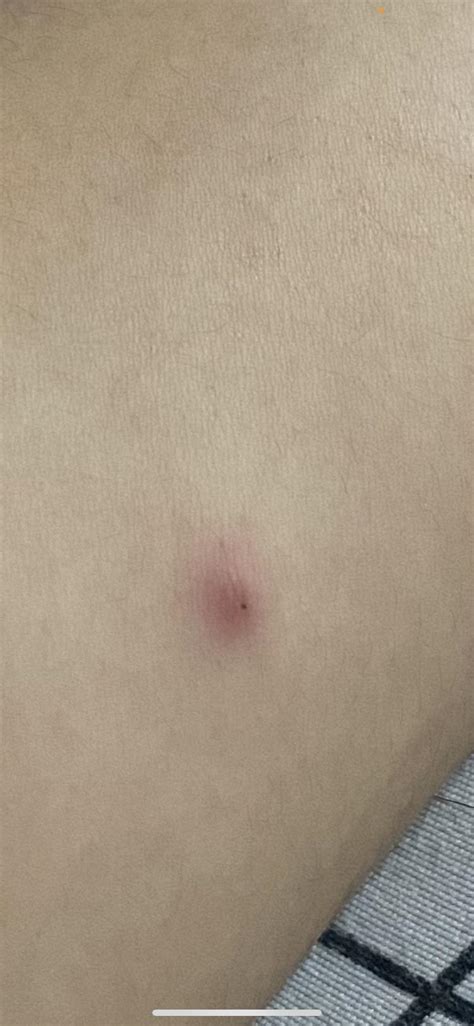 Raised Red Bump With Black Dot In The Center Rskin