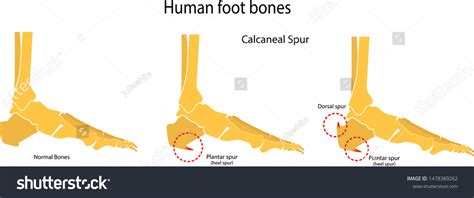 Human Foot Bones Plantar Dorsal Spur Stock Vector Royalty Free