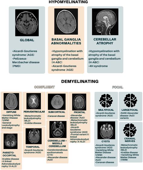 Classification Of Leukodystrophies In Hypomyelinating And Demyelinating