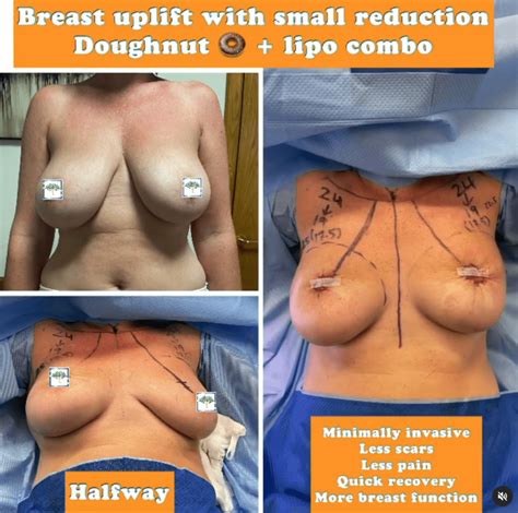 Breast Reduction Scars Before And After Harley Clinic