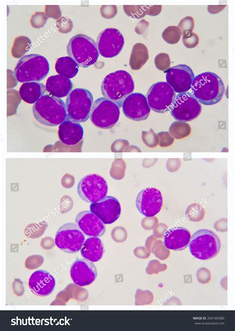Human Blood Smear Leukemia Myeloblast Cells 스톡 사진 204185980 Shutterstock