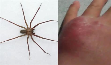 La Picadura De Araña Violinista Síntomas Y Prevención Vanessa Mae