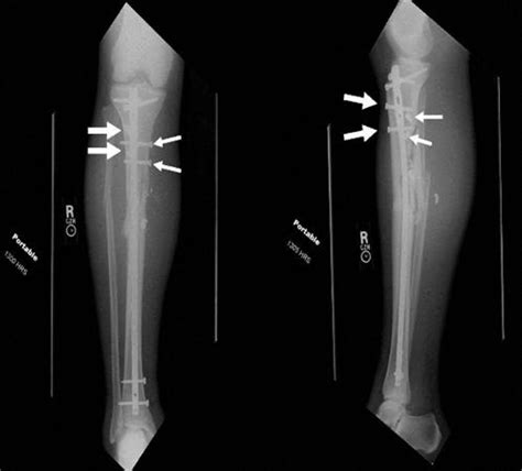 Proximal Third Tibia Fracture Trauma Orthobullets