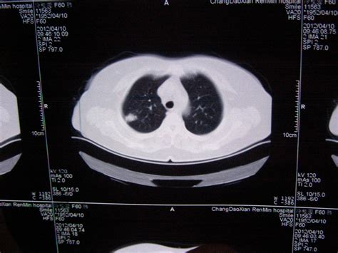 10 健康 肺 Ct Ideas Edsfwfa
