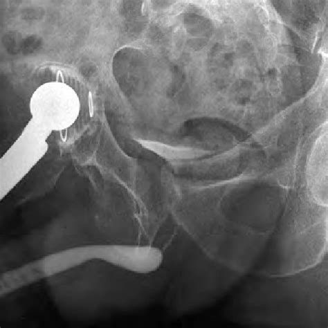 Patient M 58 Y O Ct Urethrography 1 Year After Surgery Voiding