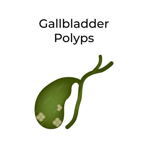 Premium Vector Gallbladder Polyps Vector Illustration