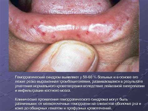 Изменения слизистой оболочки полости рта при болезнях крови