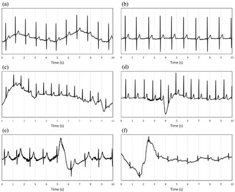 Validation Of A New And Straightforward Algorithm To Evaluate Signal