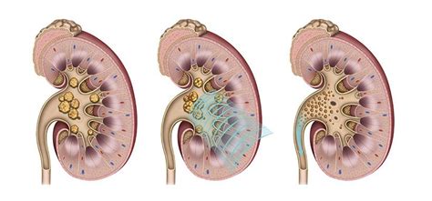 Holmium Laser Lithotripsy In La Plata Md Urologist In La Plata Md