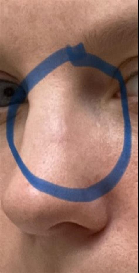 Misc Fibrous Papule Angiofibroma Natural Remedies Rskincareaddiction