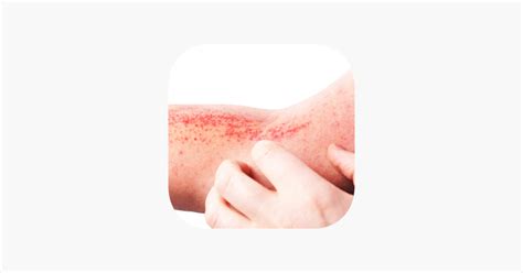 ‎managing Atopic Dermatitis On The App Store