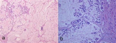 A Pools Of Extracellular Mucin Containing Glandular Configurations B