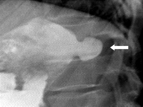 Laparoscopic Gastric Diverticulectomy In A 13 Year Old Girl Surgical Laparoscopy Endoscopy