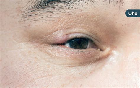 男長針眼越來越大顆，就醫竟罹患「皮脂腺癌」！眼科醫：注意3變化uho優活健康網