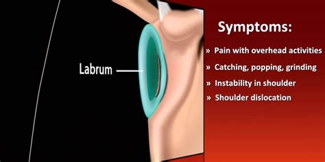 How To Identify And Diagnose A Shoulder Labrum Tear Key Symptoms Now