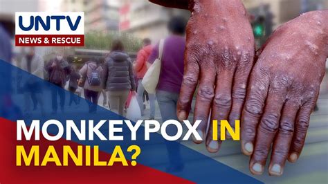 Doh Gathering Info About Monkeypox Case Reported In Manila Hk Flight