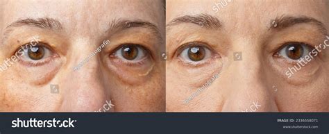 4 Concealer Before After Mature Woman Royalty Free Photos And Stock