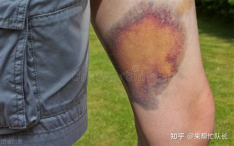 身上总是莫名的青一块紫一块？这种瘀青可能是身体发出的警报！ 知乎