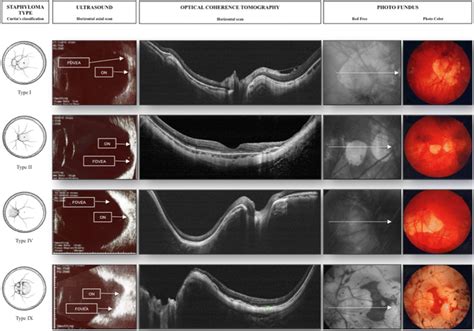 Posterior Staphyloma Types B Scan Us Oct Rf And Photo Color Images Download Scientific