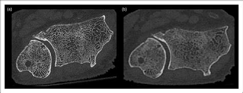 Figure 3 From Photon Counting Detector Computed Tomography Pcd Ct An Emerging Technology In