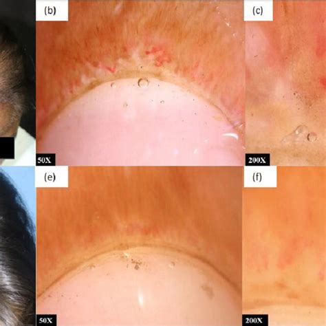 A Sle With Diffuse Alopecia Bc Nfc Showing Dilated Tortuous