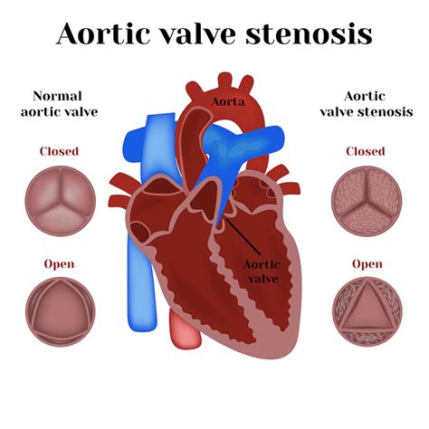 Aortic Valve Disease In Elderly