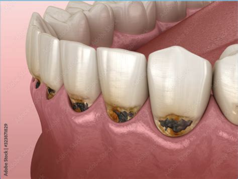 Lecture 19 Class V Composite Restoration Flashcards Quizlet