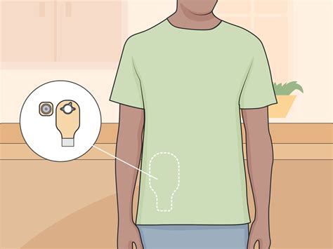 Learning To Live With Your Ostomy Lifestyle Adjustments And Tips