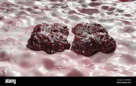 Cancer Cell Growth Uncontrollably Over Tissue Tumor Infection Cells