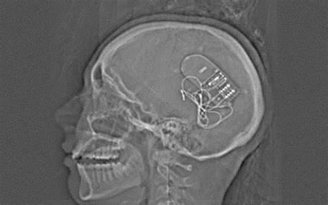 Refractory Epilepsy Chop Open