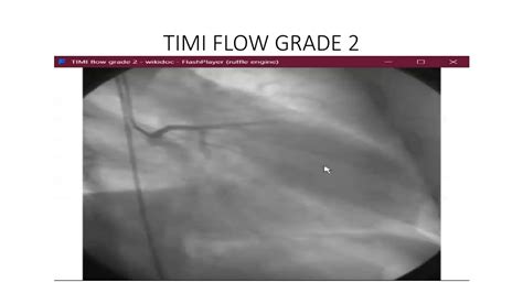 Ppt Timi Grading Of Flow Thrombus Collaterals Scad Dissection