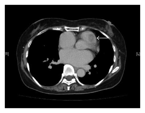 Papillary Fibroelastoma Of The Right Ventricular Free Wall Pmc