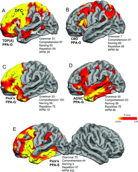 Individual Cases With Agrammatic And Semantic Ppa Variants Yellow And