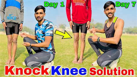Knock Knee कैसे ठीक करें Knock Knee Problem Solution Knock Knees