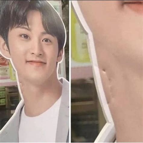 Bite Marks On Neck