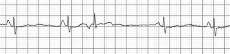 Atrial Premature Complexes Ecgpedia