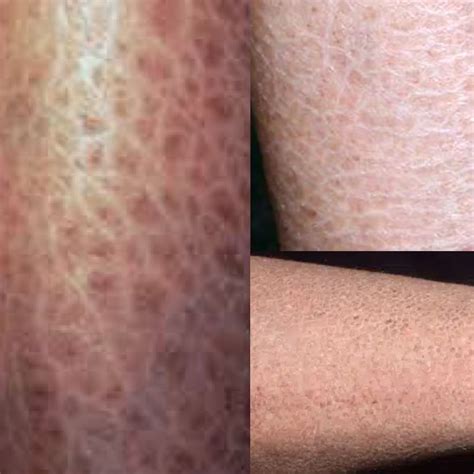 Skincare Tip Of The Day 328 Ichthyosis Vulgaris Is A Common Skin