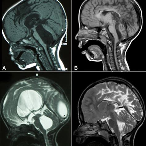 Preoperative Coronal A And Axial B T2 Weighted MRI Sequence And