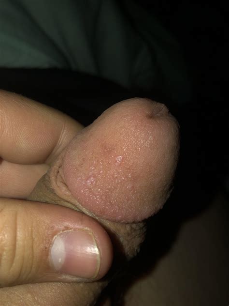 Are These Normalize Never Had Sex Idk What They Are Rmedical