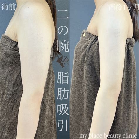 脂肪吸引（二の腕） 二の腕の脂肪吸引の症例写真・画像 My Place Beauty Clinic （マイプレイスビューティー