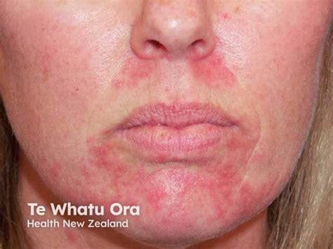 Perioral Dermatitis Skin